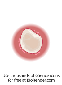 Free Ulcer (shape 2) Icons, Symbols & Images | BioRender