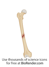 Free Femur (anterior, fracture) Icons, Symbols & Images | BioRender