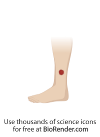 Free Lower leg (lateral with chronic wound) Icons, Symbols & Images ...