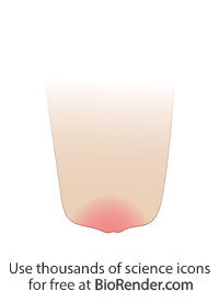 Free Limb (amputation stump, infected) Icons, Symbols & Images | BioRender