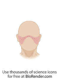 Free Malar rash (male) Icons, Symbols & Images | BioRender