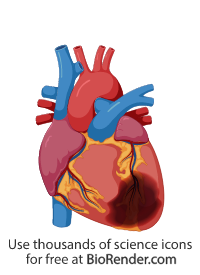 Free Heart (myocardial infarction) Icons, Symbols & Images | BioRender