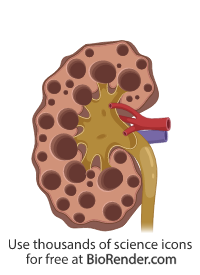 Free Kidney (polycystic, cut) Icons, Symbols & Images | BioRender