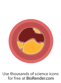 Free Atherosclerosis (cross-section, 2. fibrous plaque) Icons, Symbols ...