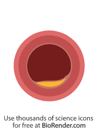 Free Atherosclerosis (cross-section, 1a. fatty streak) Icons, Symbols ...