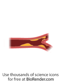 Free Atherosclerosis (1c. atheroma) Icons, Symbols & Images | BioRender