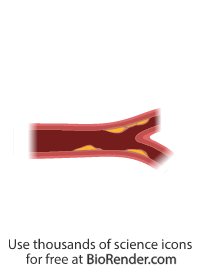 Free Atherosclerosis (1b. Intermediate lesion) Icons, Symbols & Images ...