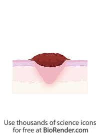 Free Skin epithelium (wound with scab, mouse) Icons, Symbols & Images ...