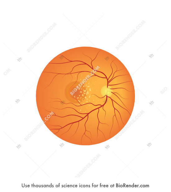 Free Geographic atrophy of retina (early) Icons, Symbols & Images ...