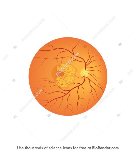 Free Geographic atrophy of retina (intermediate) Icons, Symbols ...