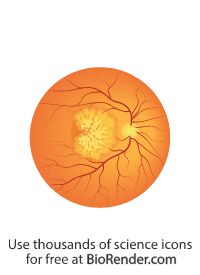 Free Geographic atrophy of retina (advanced) Icons, Symbols & Images ...