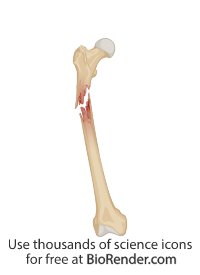 Free Femur fracture (multiple myeloma, anterior) Icons, Symbols ...
