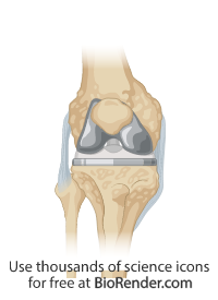 Free Total knee replacement (arthritis) Icons, Symbols & Images | BioRender