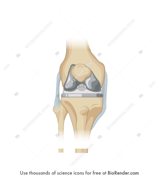 Free Total knee replacement (normal) Icons, Symbols & Images | BioRender