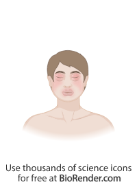 Free Angioedema (adult) Icons, Symbols & Images | BioRender