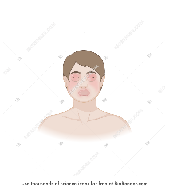 Free Angioedema (adult) Icons, Symbols & Images | BioRender