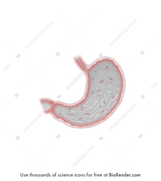 Free Gastritis Icons, Symbols & Images | BioRender