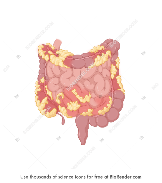 Free Ileocolitis Icons, Symbols & Images | BioRender