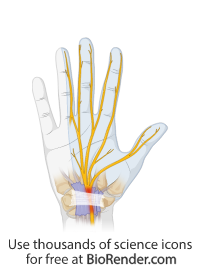 Free Carpal tunnel syndrome (with affected area) Icons, Symbols ...