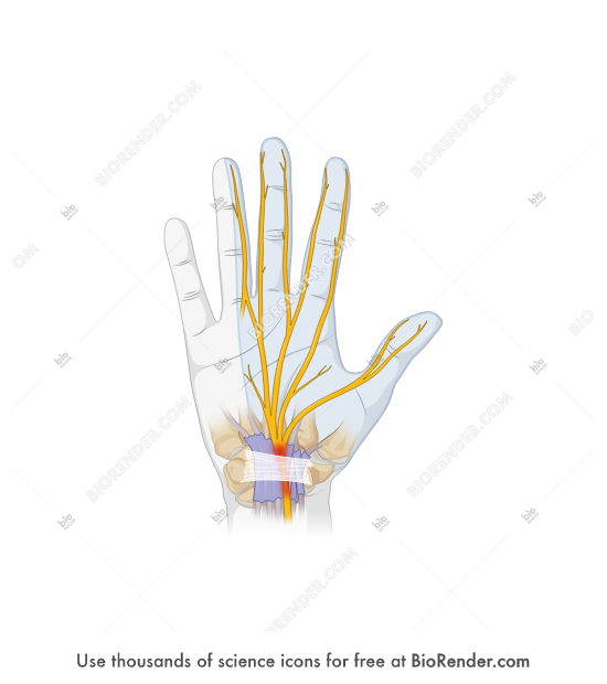 Free Carpal tunnel syndrome (with affected area) Icons, Symbols ...