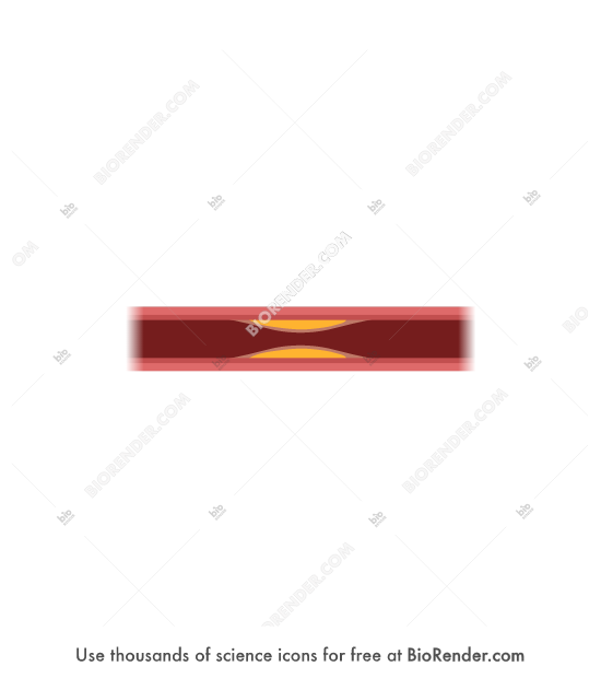 Free Blood vessel (cut, atherosclerosis) Icons, Symbols & Images ...