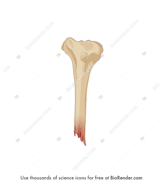 Free Tibial shaft fracture (complete, proximal half, anterior) Icons ...