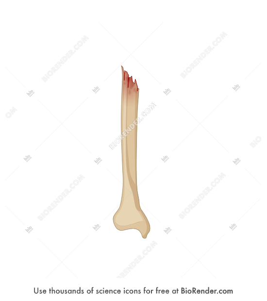 Free Tibial shaft fracture (complete, distal half, anterior) Icons ...