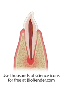 Free Apical periodontitis (primary incisor) Icons, Symbols & Images ...