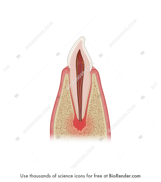 Free Apical periodontitis (primary incisor) Icons, Symbols & Images ...