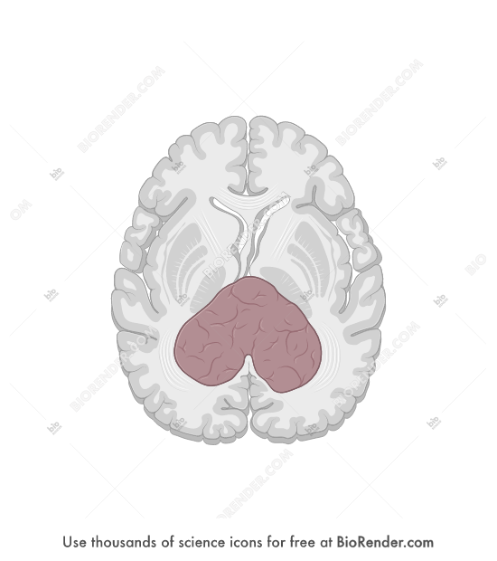 Free Butterfly glioblastoma (in brain, horizontal cut) Icons, Symbols ...