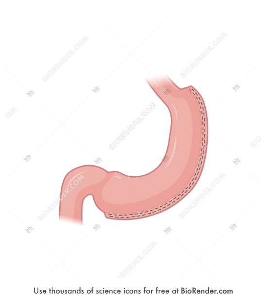Free Sleeve gastrectomy (remaining stomach) Icons, Symbols & Images ...