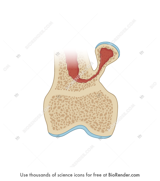 Free Femur (distal end, cross-section, osteochondroma) Icons, Symbols ...