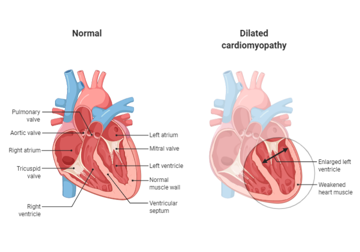 Dilated Cardiomyopathy | BioRender Science Templates