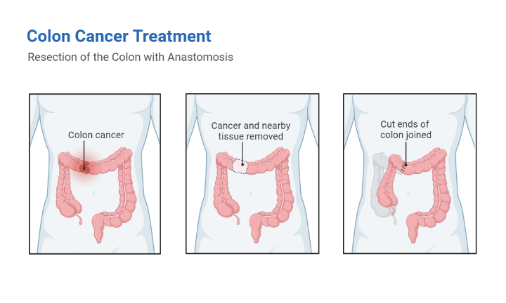 Colon Cancer Treatment Anastomosis | BioRender Science Templates