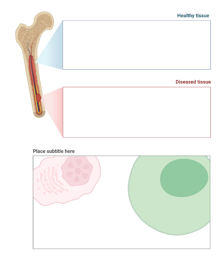 Healthy and Diseased Bone Marrow with Callout (Layout 1) | BioRender ...