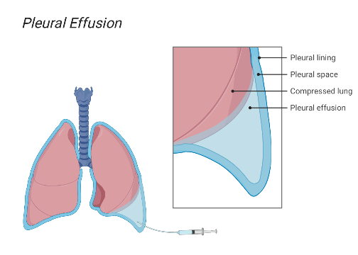 Pleural Effusion with Callout | BioRender Science Templates