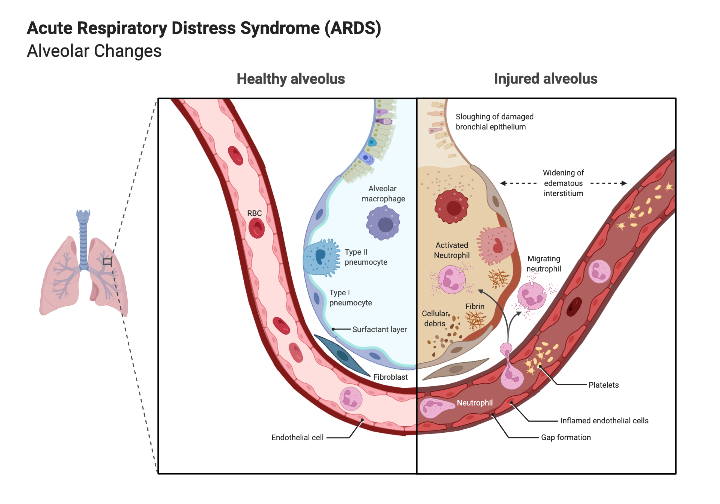 Acute Respiratory Distress Syndrome (ARDS) | BioRender Science Templates