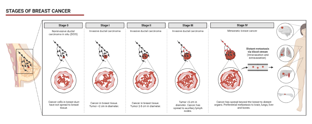 Stages of Breast Cancer | BioRender Science Templates
