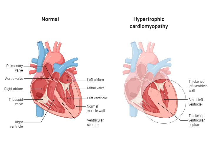 Hypertrophic Cardiomyopathy | BioRender Science Templates