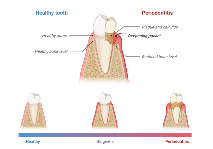 Periodontitis Comparison | BioRender Science Templates