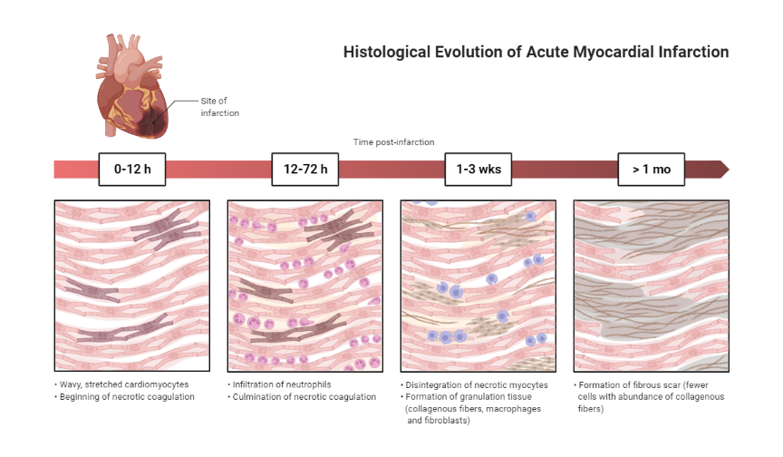 Histological Evolution Of Acute Myocardial Infarction BioRender Histological Evolution Of Acute Myocardial Infarction BioRender
