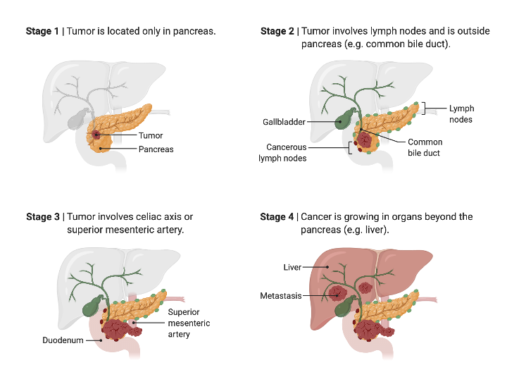 Pancreatic Cancer Staging | BioRender Science Templates