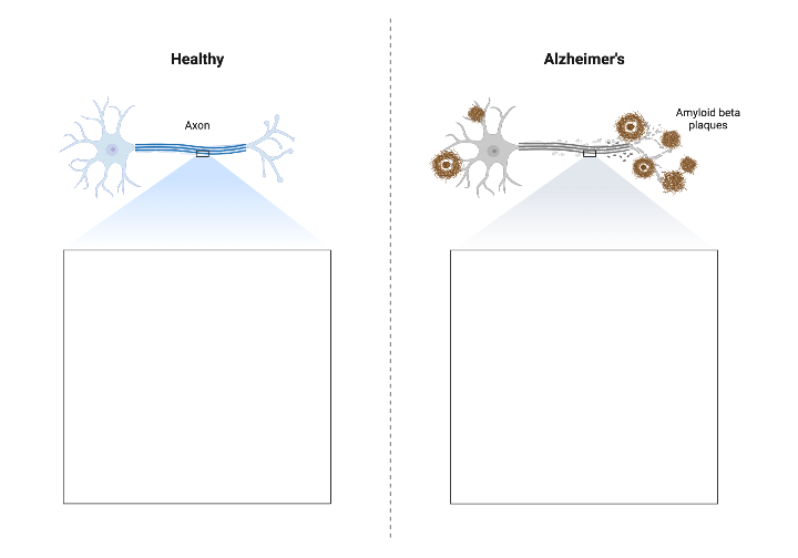 Comparison of Healthy Neuron and Neuron of Alzheimer's Patient with ...