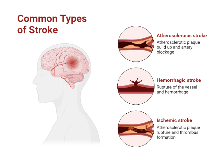Common Types of Stroke | BioRender Science Templates
