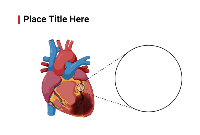 Heart Attack (Layout) | BioRender Science Templates
