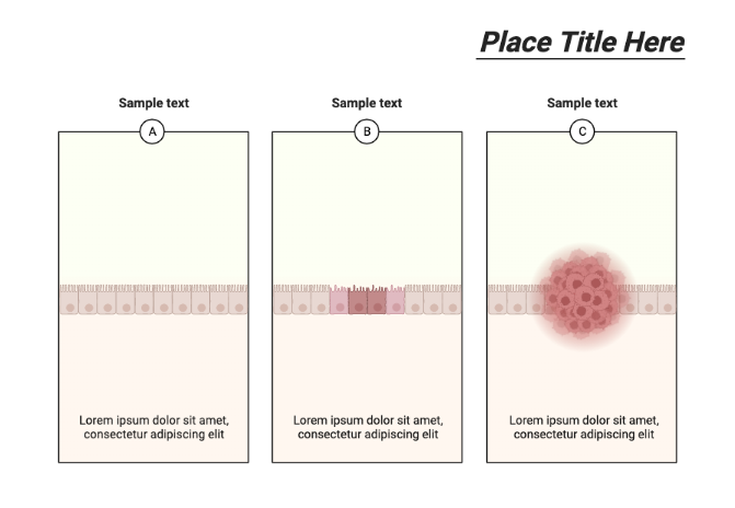 Colon Cancer Progression (Layout 3x1) | BioRender Science Templates
