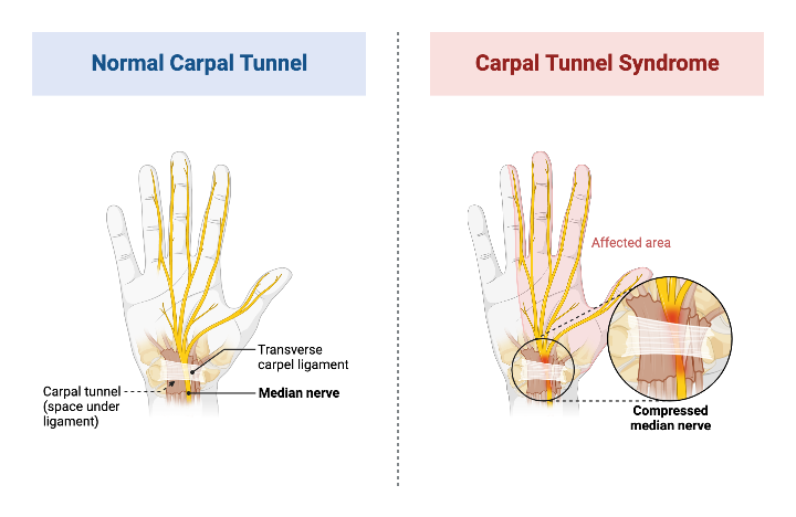 Carpal Tunnel Syndrome | BioRender Science Templates