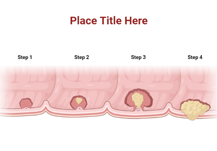 Colorectal Cancer Progression (Layout) | BioRender Science Templates
