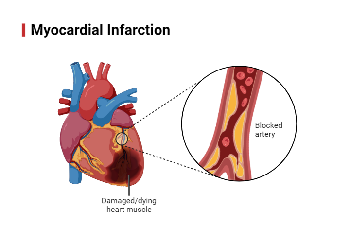 Myocardial Infarction (Heart Attack) | BioRender Science Templates