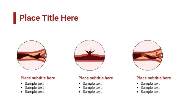 Common Types of Stroke (Layout) | BioRender Science Templates